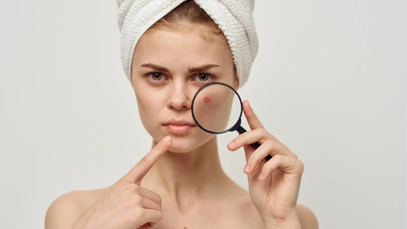 Best Medical-Grade Skincare for Acne and Breakouts | Dermshop